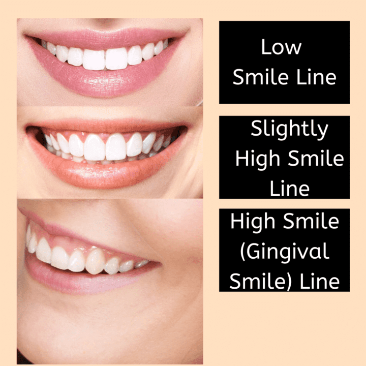 What is a Gingival Smile Line? - Empire Dental
