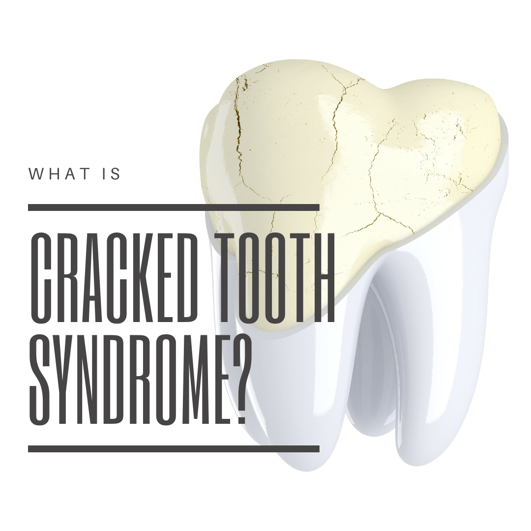 What is Cracked Tooth Syndrome? - Empire Dental
